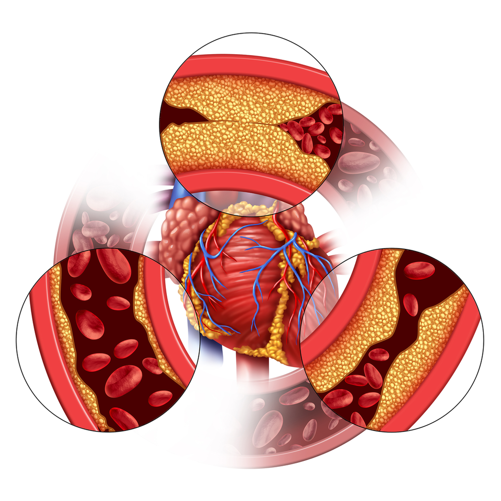 FAA Disqualifying Conditions Coronary Heart Disease Wingman